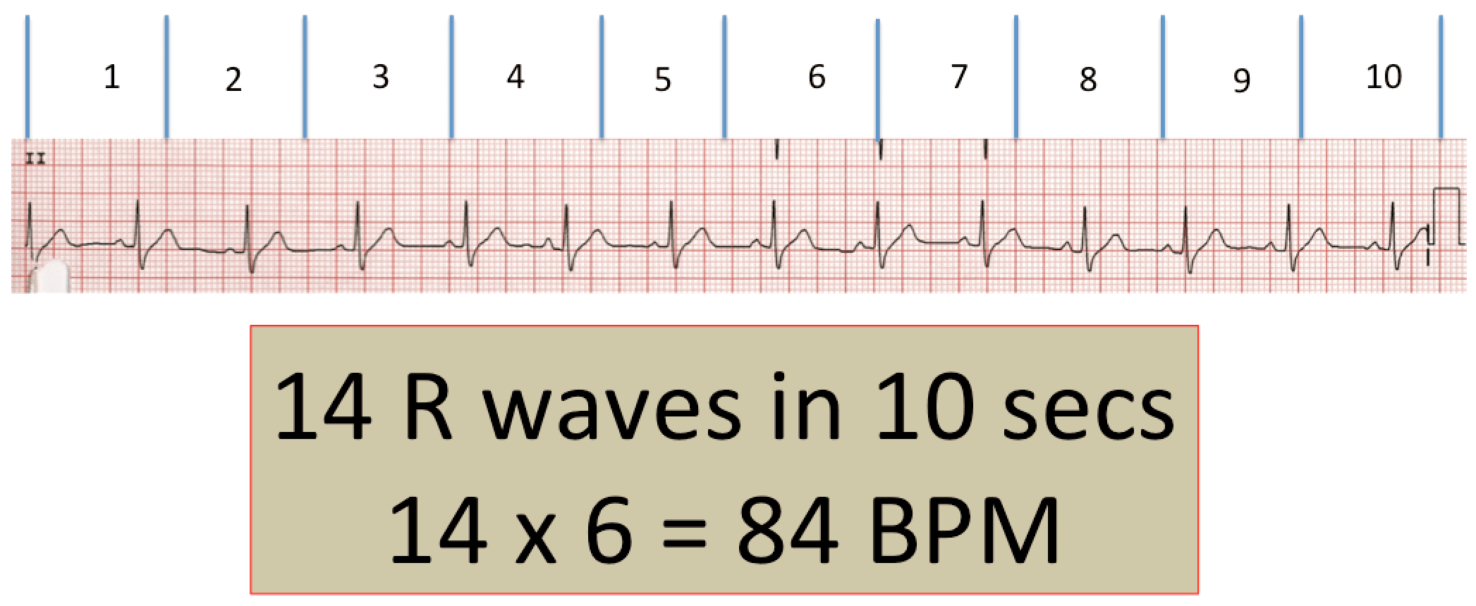 ECG Basics R E B E L EM Emergency Medicine Blog ECG Basics R E B E L EM Emergency Medicine Blog
