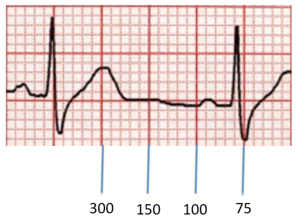 ECG Basics R E B E L EM Emergency Medicine Blog ECG Basics R E B E L EM Emergency Medicine Blog