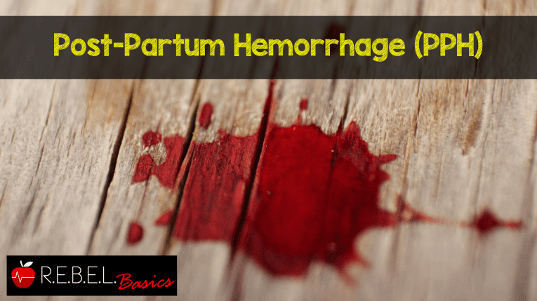Post-Partum Hemorrhage - REBEL EM - Emergency Medicine Blog Post-Partum Hemorrhage - REBEL EM - Emergency Medicine Blog