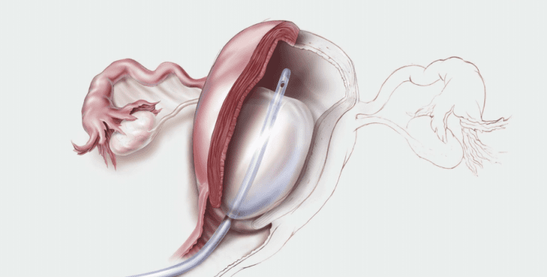 Post-Partum Hemorrhage - REBEL EM - Emergency Medicine Blog Post-Partum Hemorrhage - REBEL EM - Emergency Medicine Blog