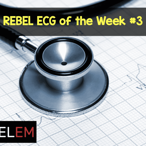 REBEL ECG of the Week #3 – MED-TAC International Corp.