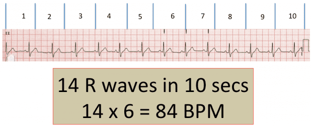 ECG Basics - REBEL EM - Emergency Medicine Blog