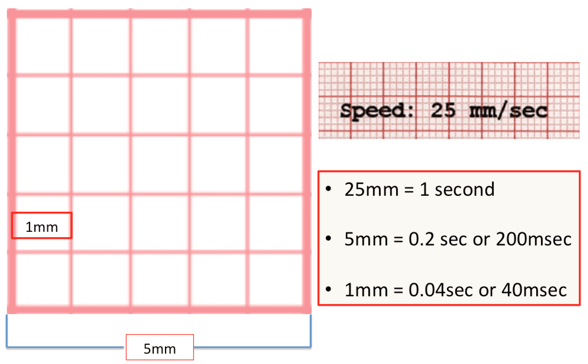ECG Rate REBEL EM Emergency Medicine Blog ECG Rate REBEL EM Emergency Medicine Blog