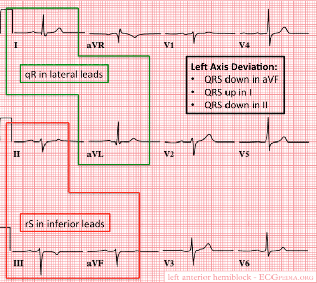 Bundle Branch Blocks: 101 - REBEL EM - Emergency Medicine Blog