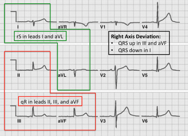 Bundle Branch Blocks: 101 - REBEL EM - Emergency Medicine Blog