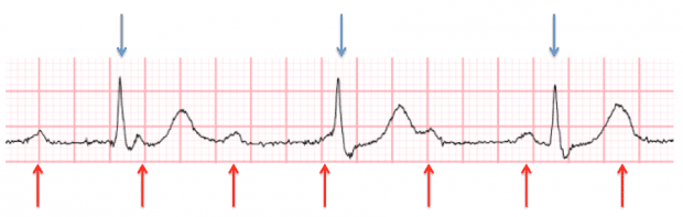 REBEL ECG of the Week #1 - REBEL EM - Emergency Medicine Blog