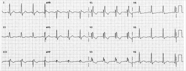 Normal RBBB - REBEL EM - Emergency Medicine Blog