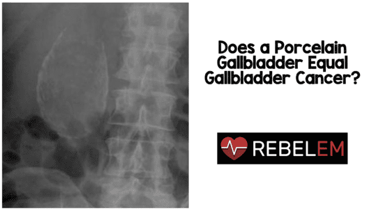 Porcelain Gallbladder - REBEL EM - Emergency Medicine Blog