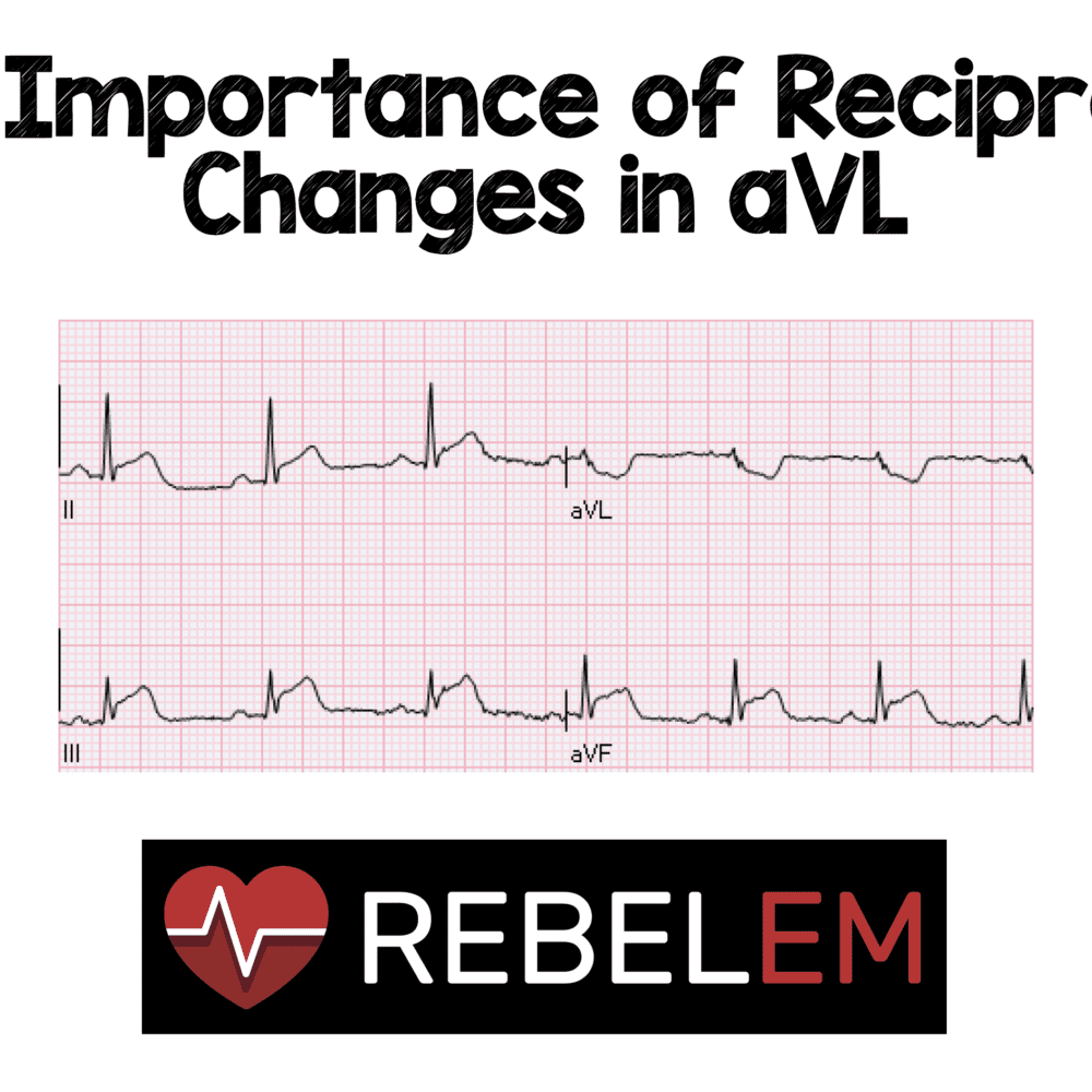 Bundle Branch Blocks: 101