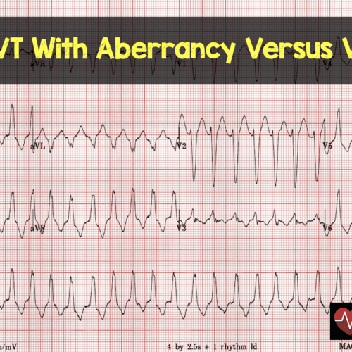 REBEL ECG of the Week #4