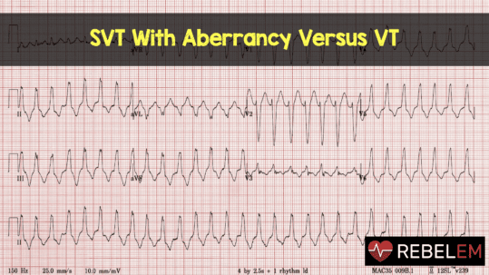 SVT With Aberrancy Versus VT - REBEL EM - Emergency Medicine Blog