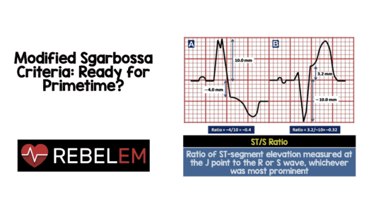 Modified Sgarbossa Criteria - REBEL EM - Emergency Medicine Blog