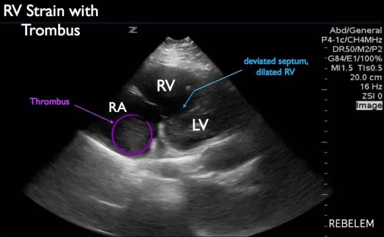 Diagnosis of Right Ventricular Strain with Transthoracic ...