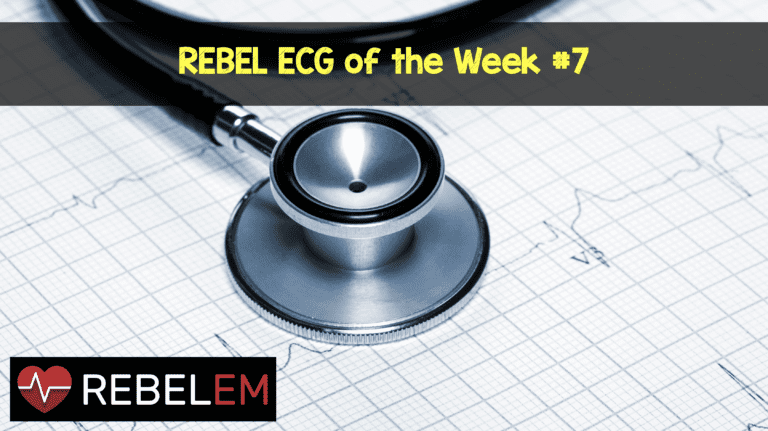 REBEL ECG of the Week 7 - REBEL EM - Emergency Medicine Blog