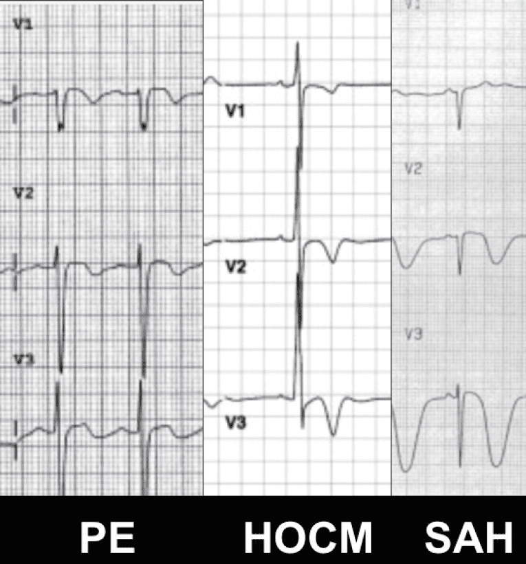 REBEL ECG of the Week #8 - REBEL EM - Emergency Medicine Blog