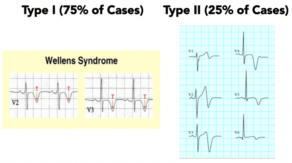 Types of Wellens' - REBEL EM - Emergency Medicine Blog