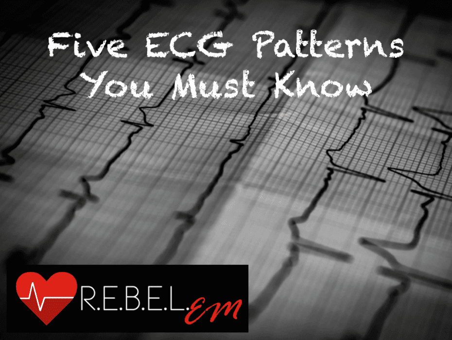 ECG Patterns - REBEL EM - Emergency Medicine Blog