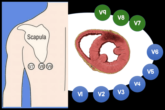Five ECG Patterns You Must Know - REBEL EM - Emergency Medicine Blog