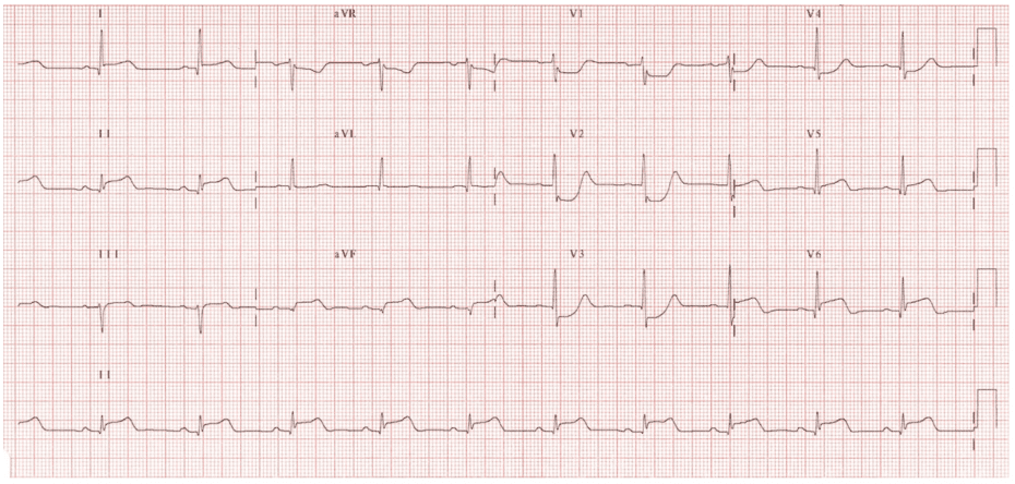 Five ECG Patterns You Must Know - REBEL EM - Emergency Medicine Blog