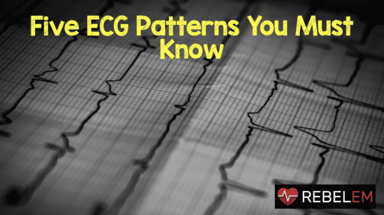 Five ECG Patterns You Must Know - REBEL EM - Emergency Medicine Blog