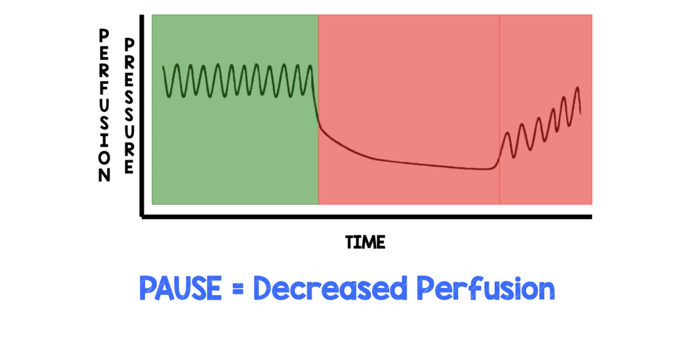 Beyond ACLS: Cognitively Offloading During a Cardiac Arrest - REBEL EM ...