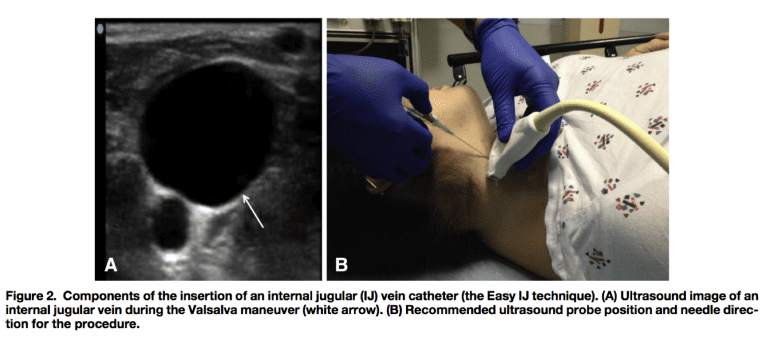 The Easy IJ: Another Option for Difficult IV Access in Stable Patients ...