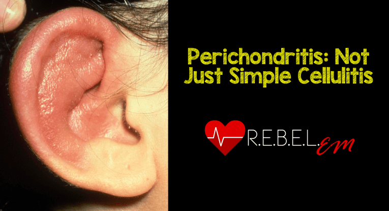 Perichondritis: Not Just Simple Cellulitis - REBEL EM - Emergency ...