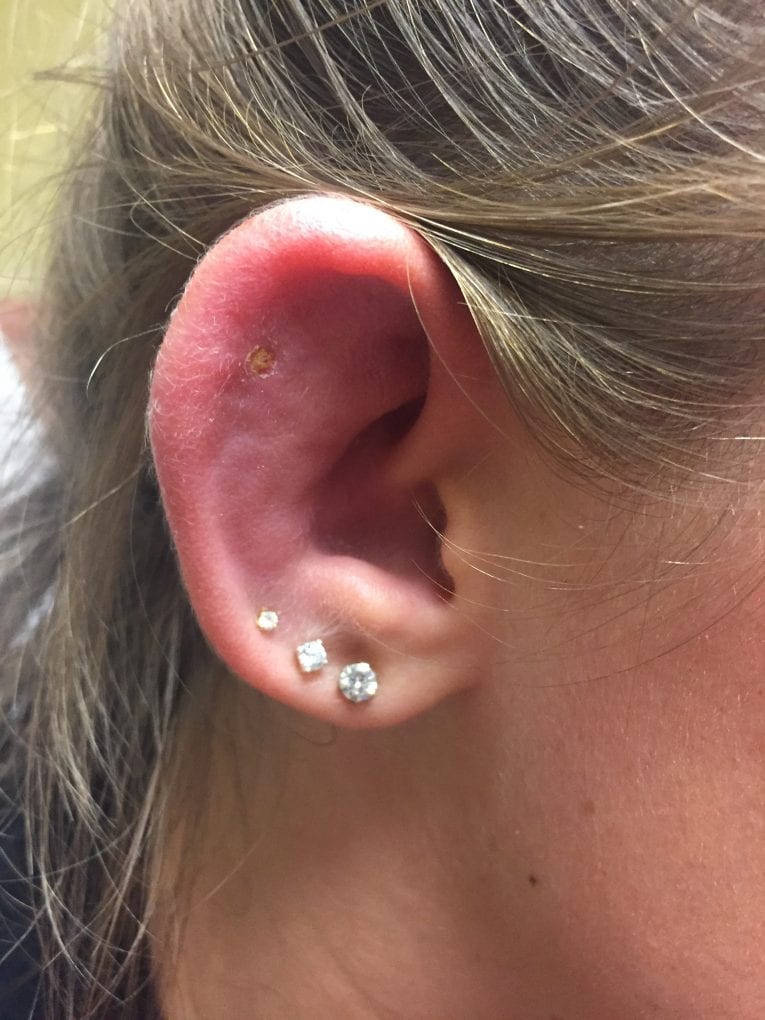 Perichondritis - REBEL EM - Emergency Medicine Blog