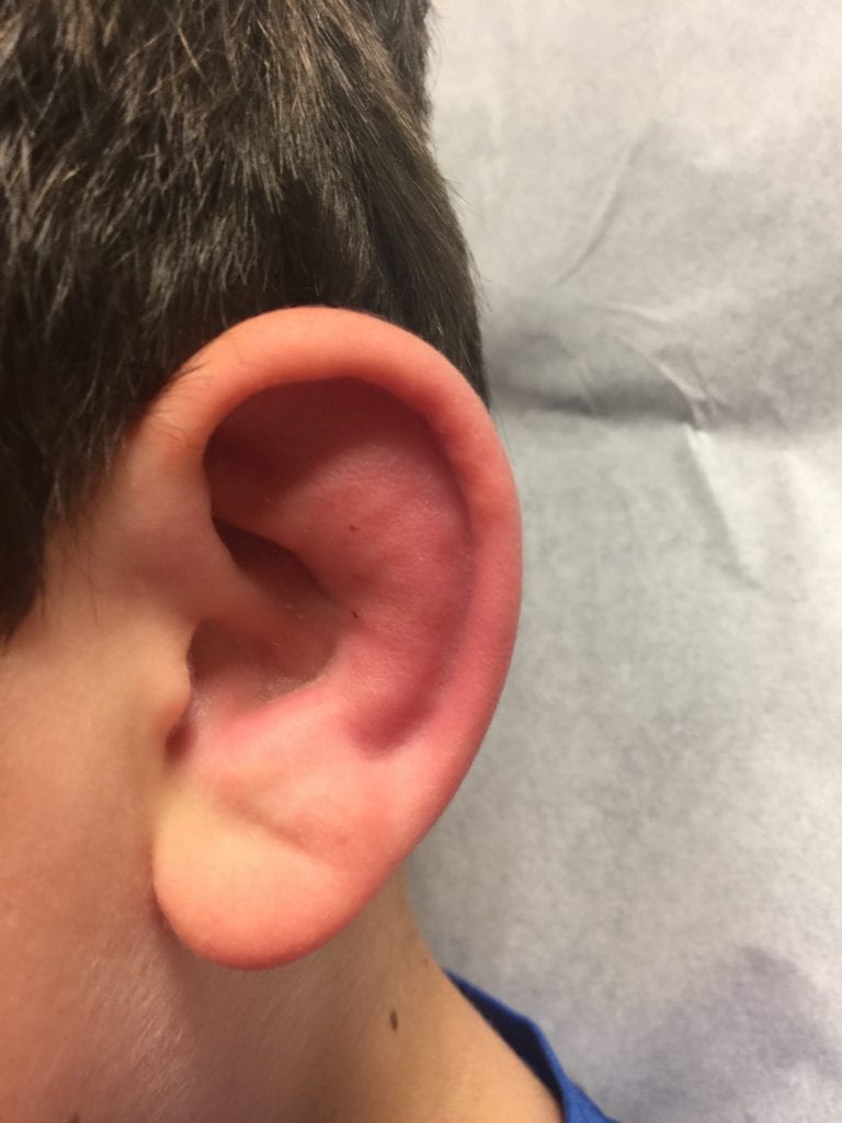 Perichondritis - REBEL EM - Emergency Medicine Blog