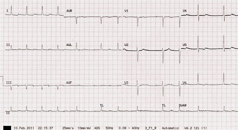 Atrial Paced Rhythm (LITFL) - REBEL EM - Emergency Medicine Blog