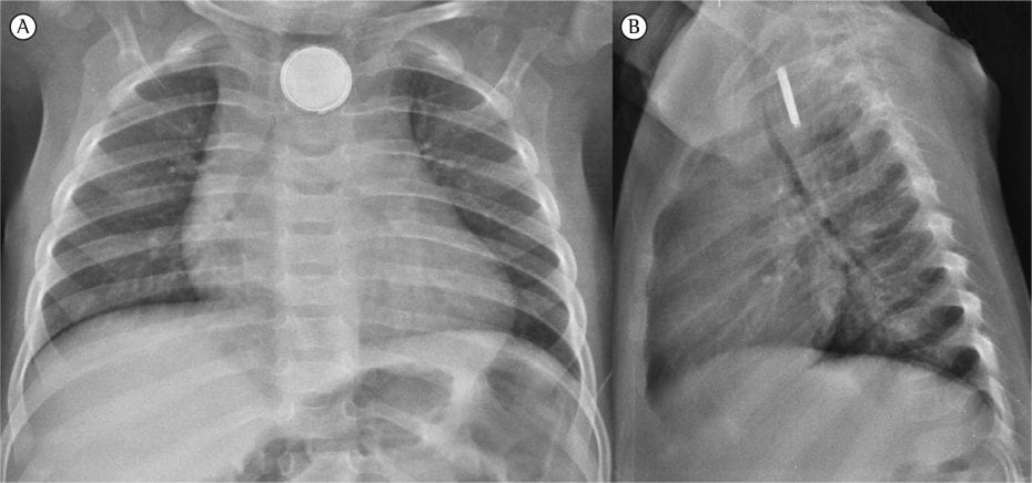 Button Battery Ingestion - REBEL EM - Emergency Medicine Blog