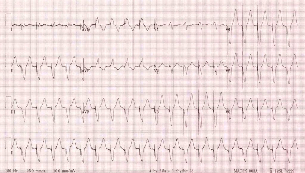 Pacemaker Basics - REBEL EM - Emergency Medicine Blog