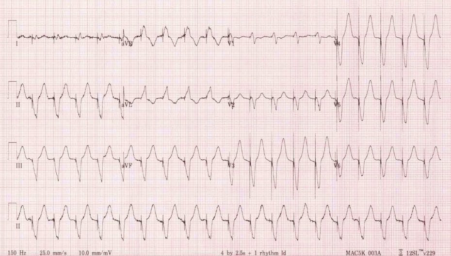Pacemaker Basics - REBEL EM - Emergency Medicine Blog