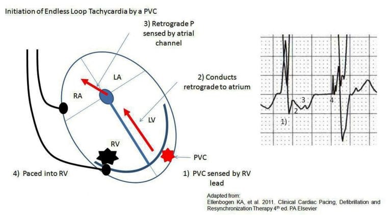 Pacemaker Basics - REBEL EM - Emergency Medicine Blog