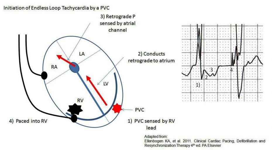 Pacemaker Basics - REBEL EM - Emergency Medicine Blog