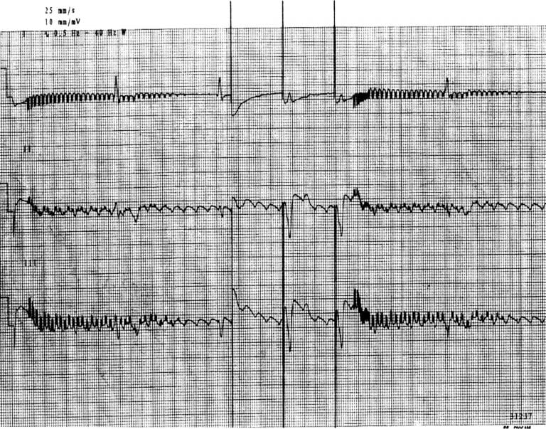 Pacemaker Basics - REBEL EM - Emergency Medicine Blog