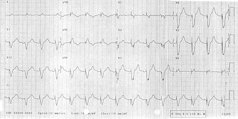 Pacemaker Basics - REBEL EM - Emergency Medicine Blog