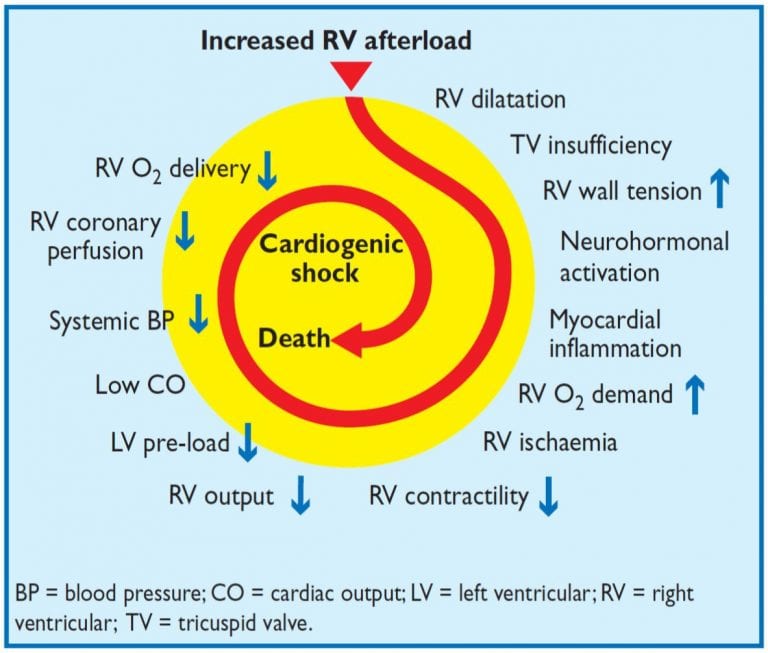 The Critical Pulmonary Embolism Patient - REBEL EM - Emergency Medicine ...
