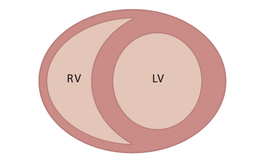 RV vs LV - REBEL EM - Emergency Medicine Blog