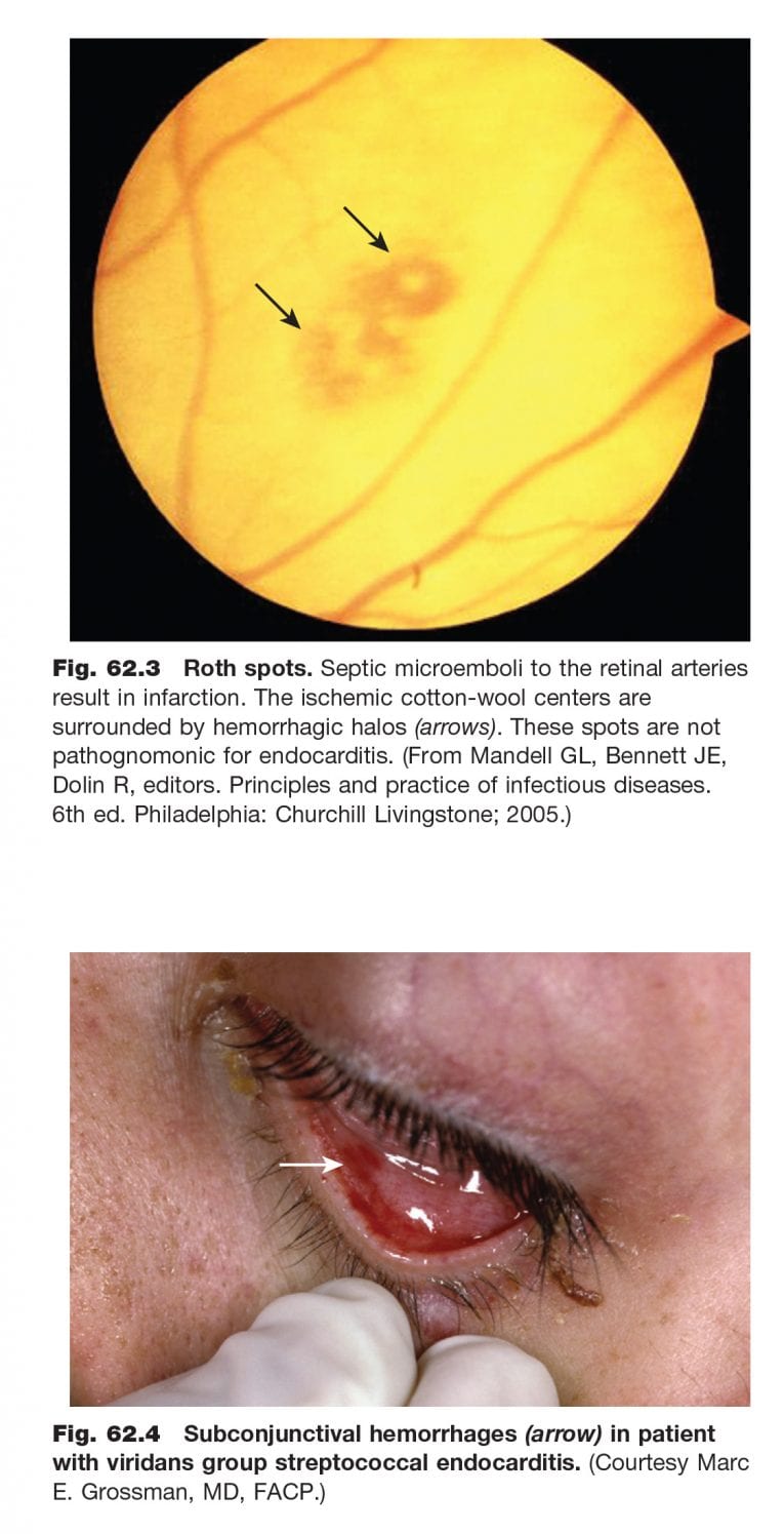 Bacterial Endocarditis - REBEL EM - Emergency Medicine Blog
