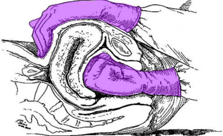 R.E.B.E.L. EM - Post-Partum Hemorrhage - emDocs