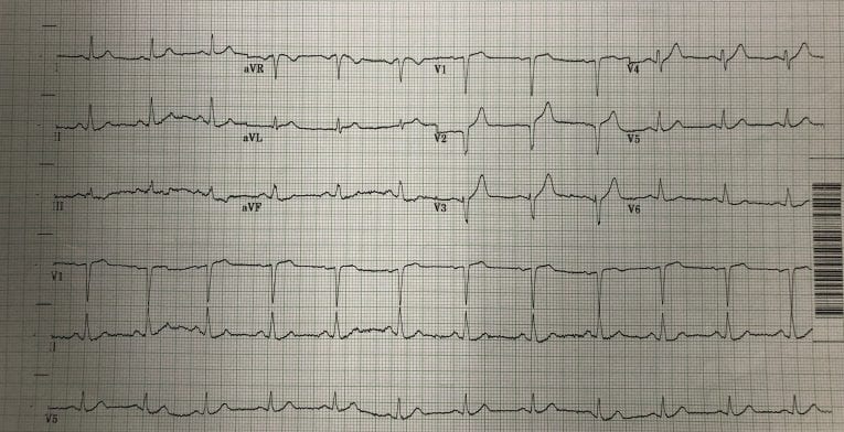 Chest Pain, "Negative" Stress Tests, POCUS, & ECG Equations - REBEL EM ...