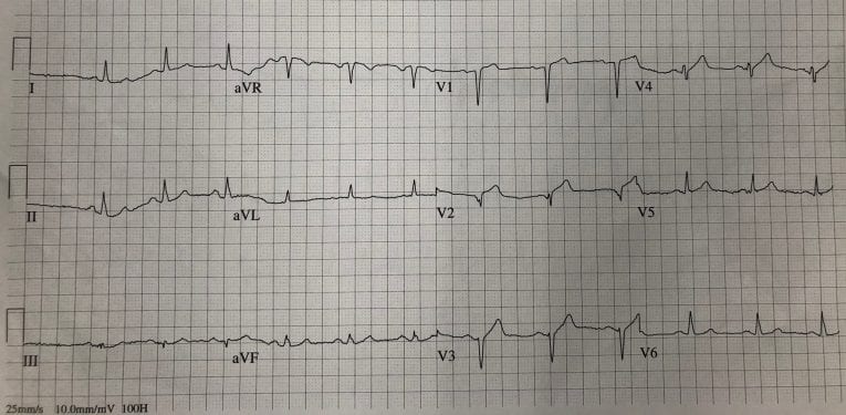 Chest Pain, "Negative" Stress Tests, POCUS, & ECG Equations - REBEL EM ...