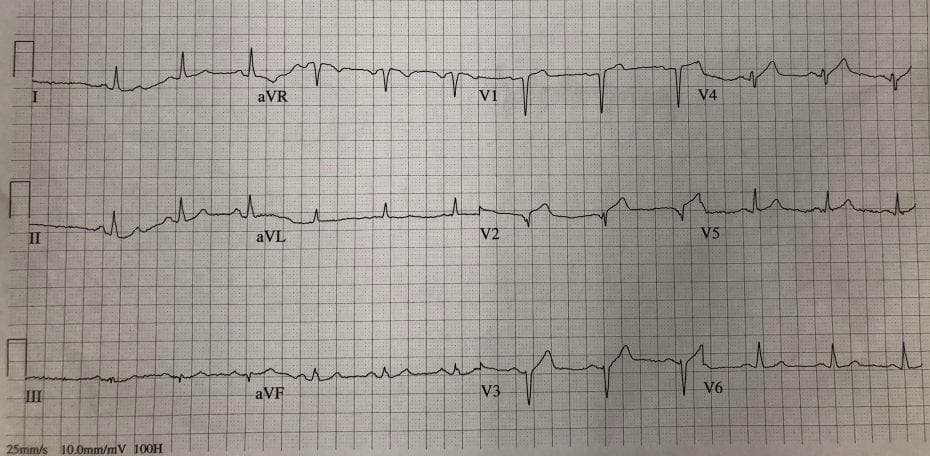 Chest Pain, "Negative" Stress Tests, POCUS, & ECG Equations - REBEL EM ...