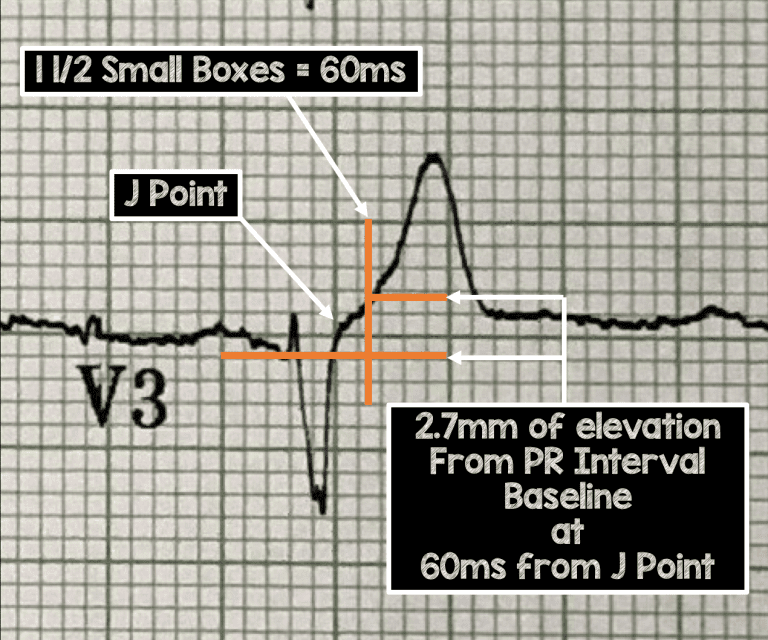 Chest Pain, "Negative" Stress Tests, POCUS, & ECG Equations - REBEL EM ...
