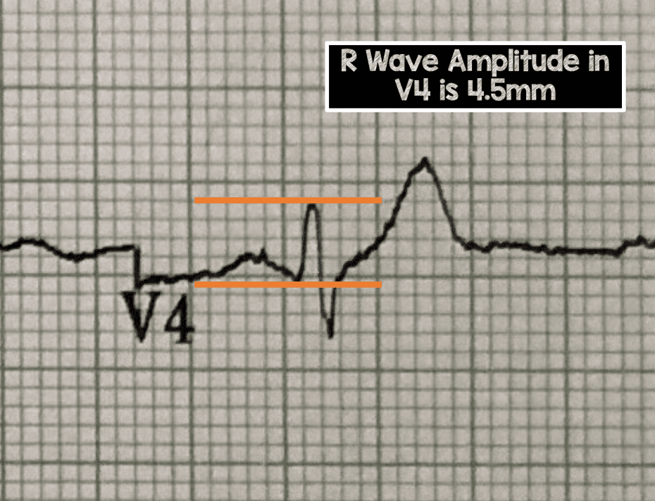 Chest Pain, "Negative" Stress Tests, POCUS, & ECG Equations - REBEL EM ...