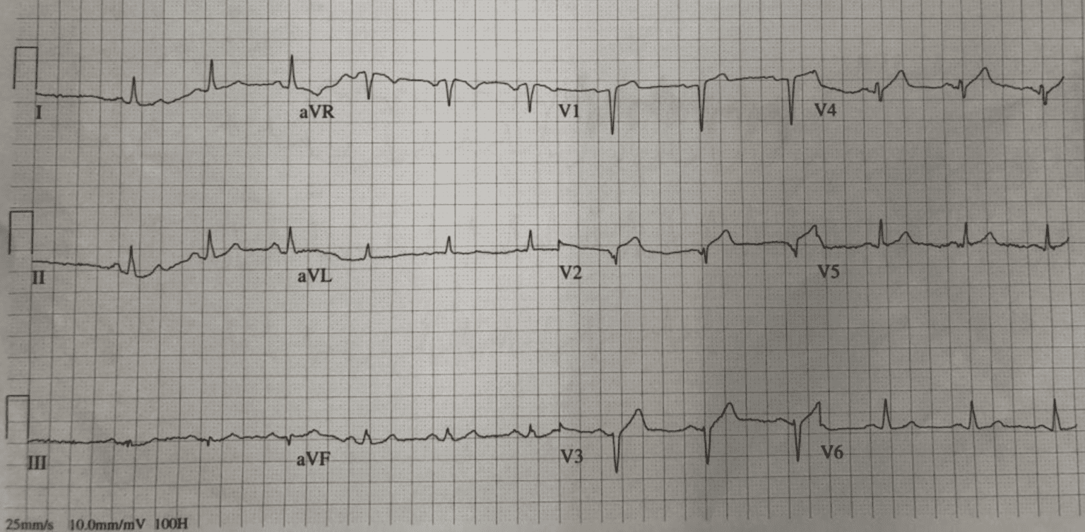 Chest Pain, "Negative" Stress Tests, POCUS, & ECG Equations - REBEL EM ...