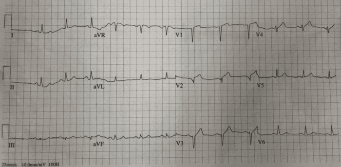 Chest Pain, "Negative" Stress Tests, POCUS, & ECG Equations - REBEL EM ...