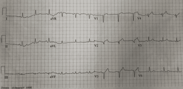Chest Pain, "Negative" Stress Tests, POCUS, & ECG Equations - REBEL EM ...