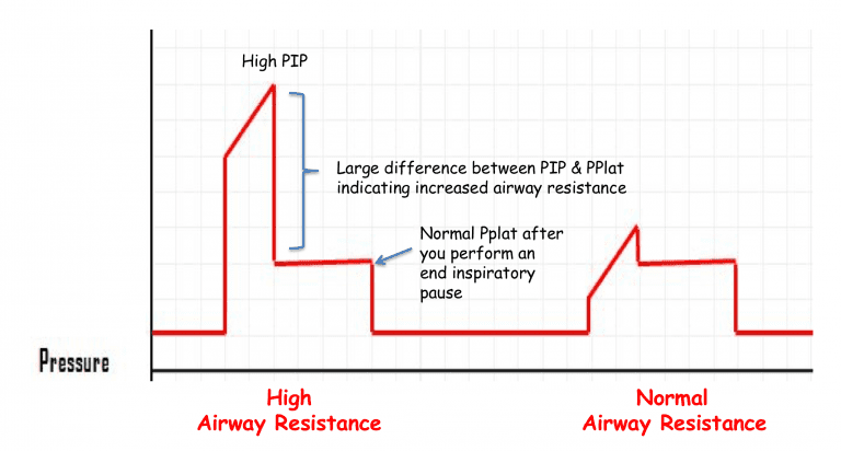Simplifying Mechanical Ventilation - Part 4: Obstructive Physiology ...